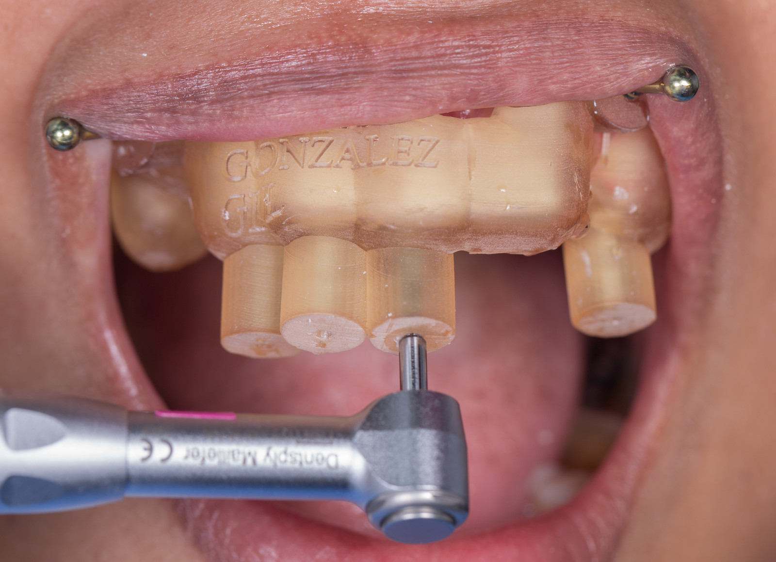 Dynamic navigation—The future of minimally invasive endodontics