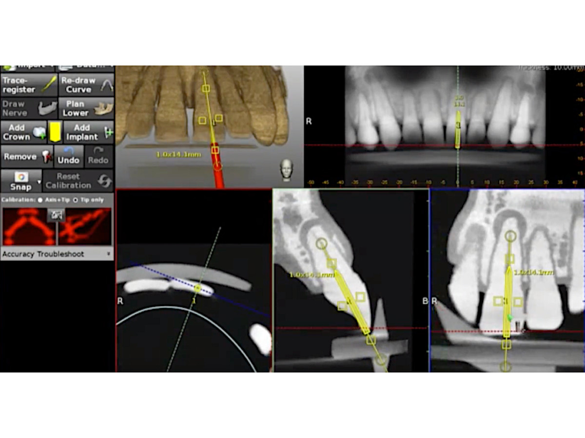 Dynamic navigation—The future of minimally invasive endodontics