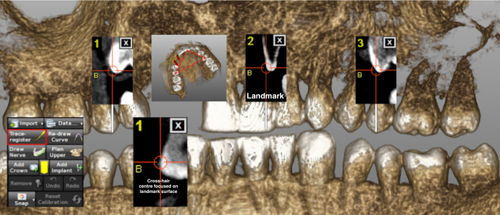 Dynamic navigation—The future of minimally invasive endodontics